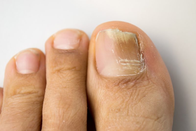 ¿Qué Es La Onicomicosis? Dermatologa Luisa Ríos Medellín
